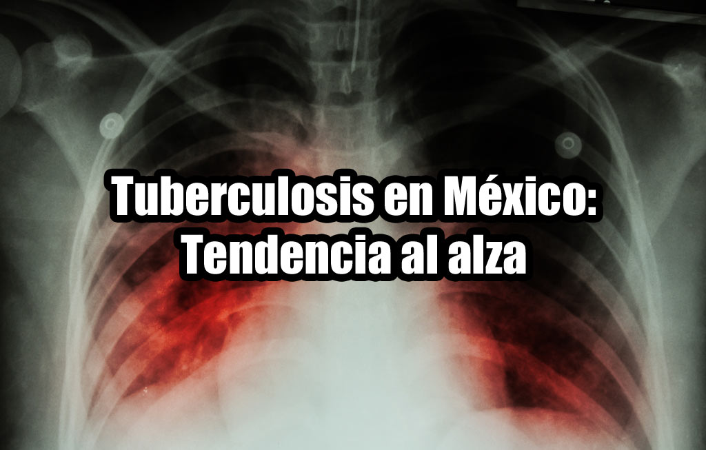 Tuberculosis en México: Tendencia al alza | Notisistema